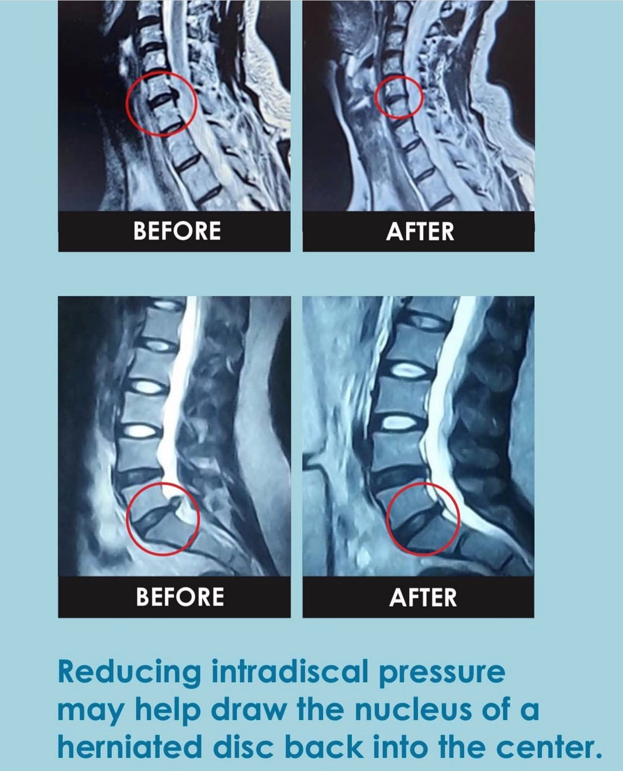 Spinal Decompression | Chiropractor | Philadelphia|19114|19115|19116|19136